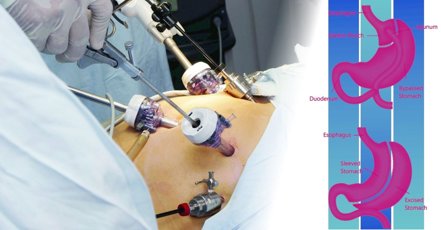 Gastric Sleeve vs Gastric Bypass Surgery - MediHealth Mexico