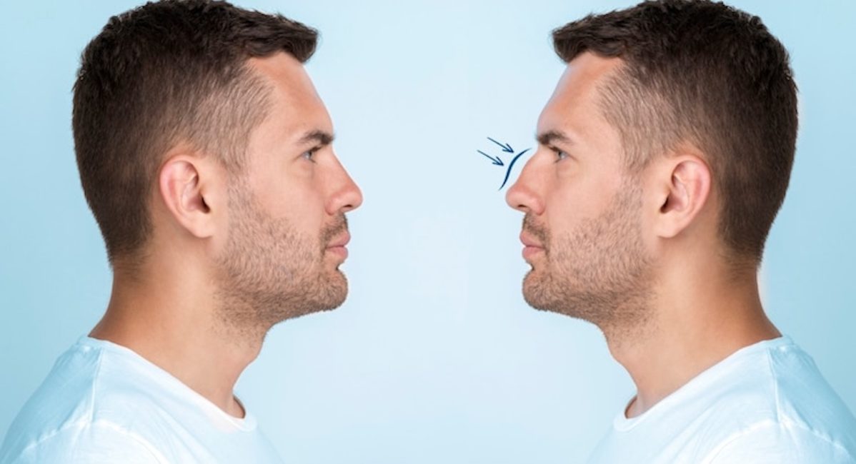 See Real Before and After Plastic Surgery Results - MediHealth Mexico